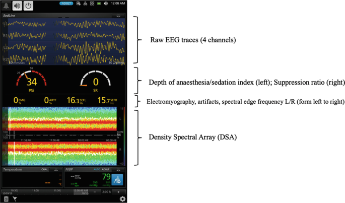 Monitoring of Sedation and Sleep in Intensive Care Unit | Springer ...