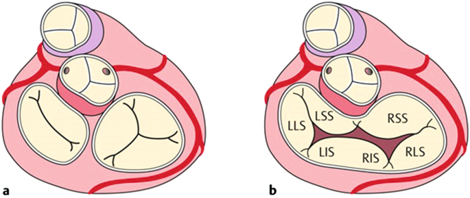 Clinical Presentation and Therapy of Atrioventricular Septal Defect ...