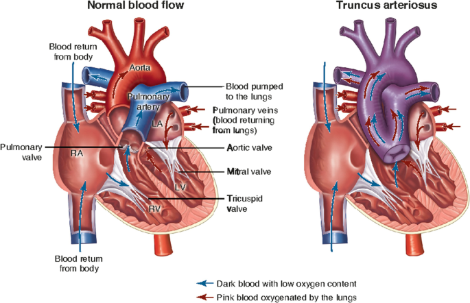 Clinical Presentation and Therapy of Truncus Arteriosus | Springer Nature Link (formally ...