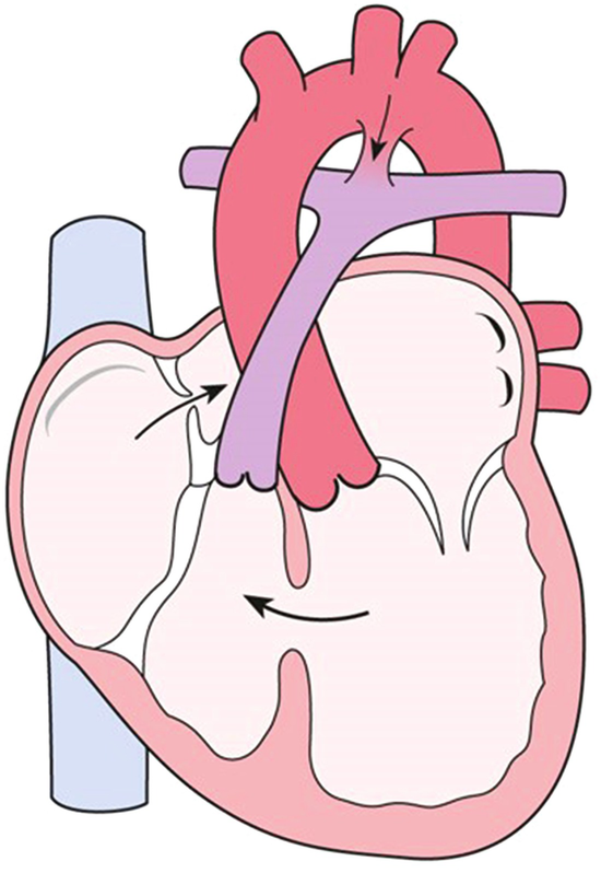 Clinical Presentation and Therapy of Tricuspid Atresia and ...
