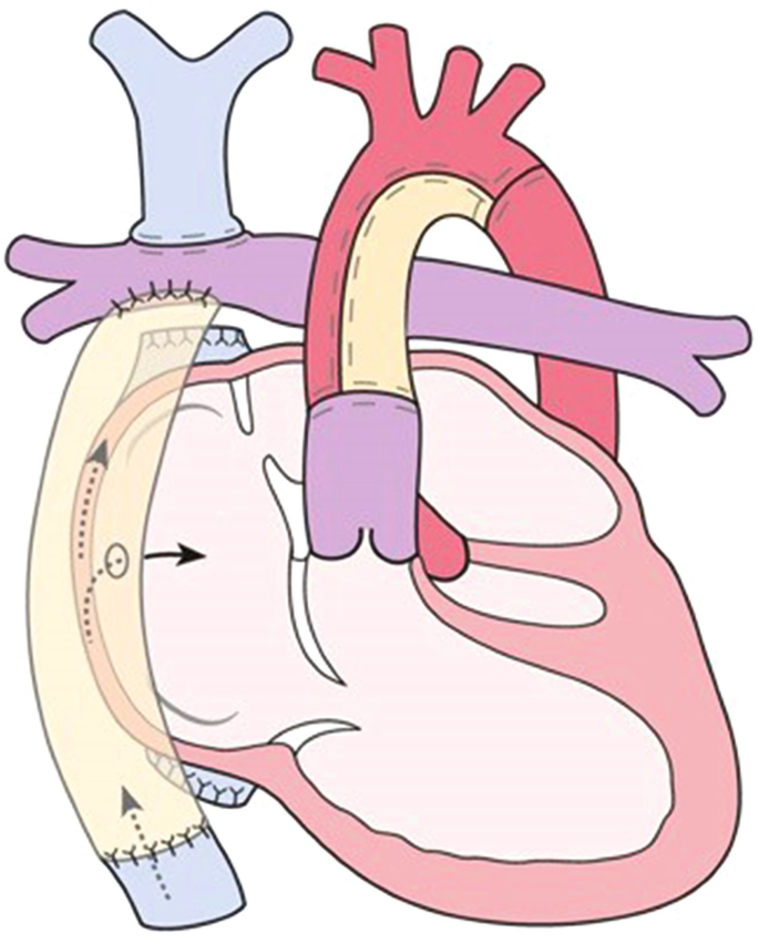 Clinical Presentation and Therapy of Tricuspid Atresia and ...
