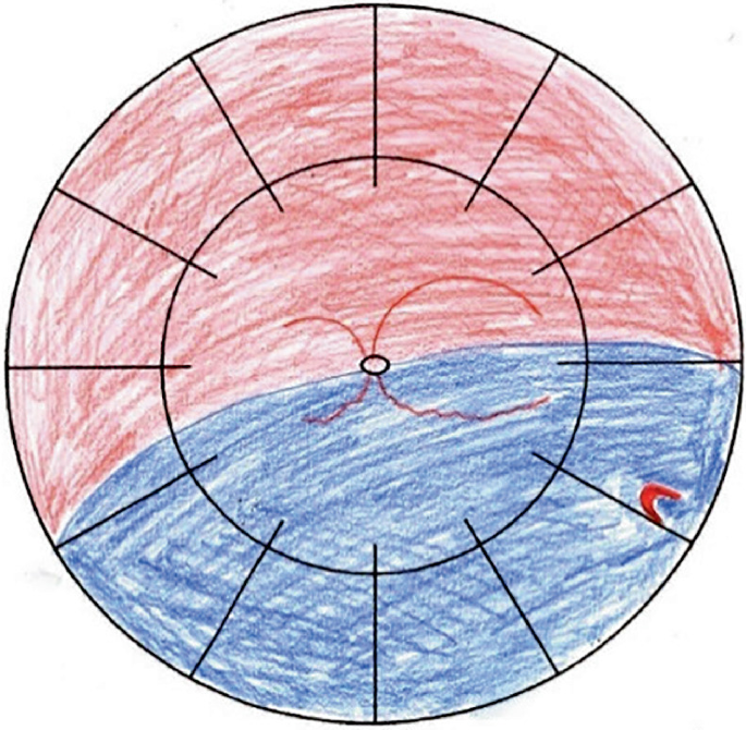 Inferiore Netzhautablösung Mit Densiron Xtra | Springer Nature Link ...