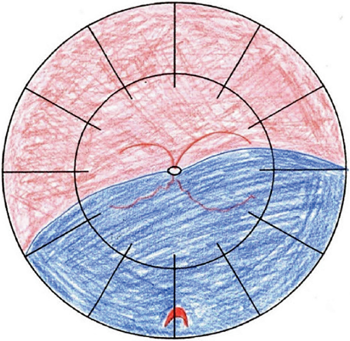 Inferiore Netzhautablösung Mit Densiron Xtra | Springer Nature Link ...