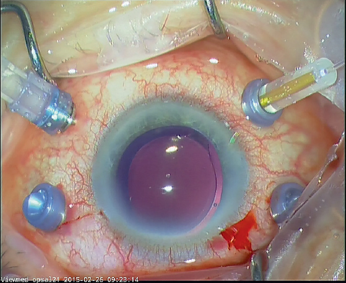 Inferiore Netzhautablösung Mit Densiron Xtra | Springer Nature Link ...
