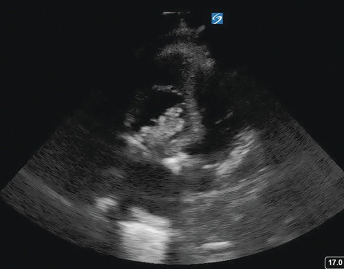 Tricuspid and Pulmonic Valve | SpringerLink