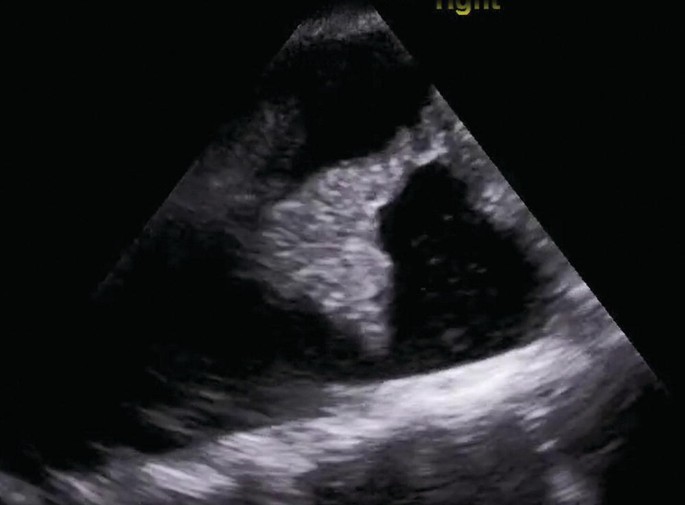 Lung Ultrasonography | SpringerLink