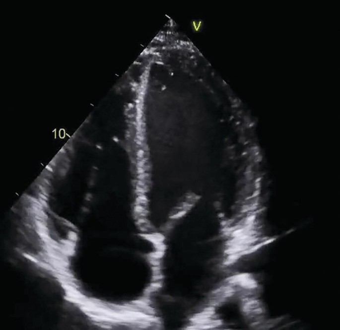 Pulmonary Hypertension, Pulmonary Embolism and ARDS | SpringerLink