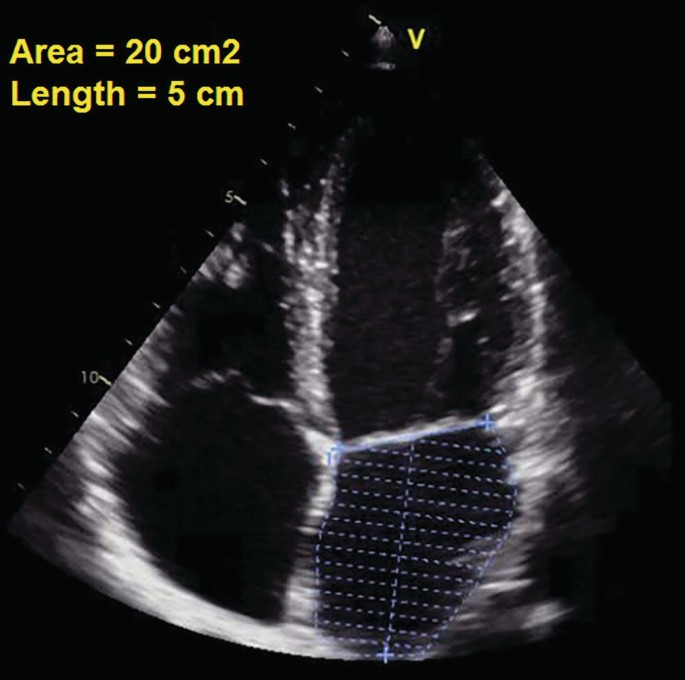 Left Ventricular Diastolic Function in the Critically Ill | SpringerLink