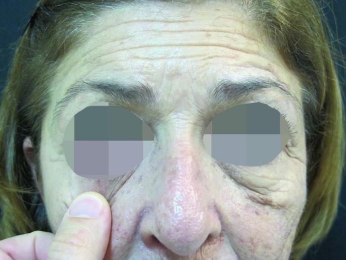 Obere und untere Blepharoplastik | SpringerLink