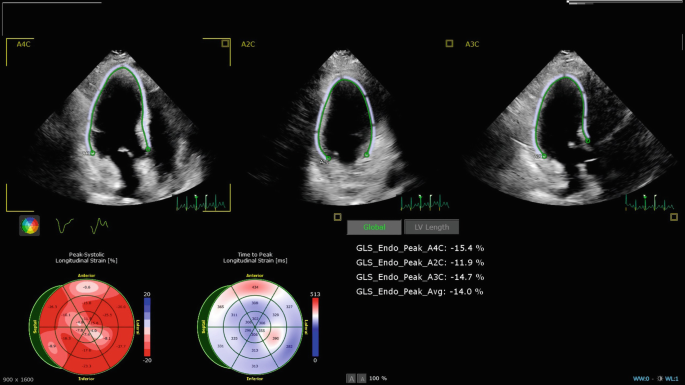 Cardio-Oncology: Cancer and Treatment-Related Cardiotoxicity and ...