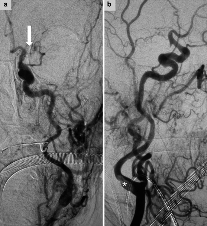 Mechanical Thrombectomy of a Free-Floating Thrombus from the Proximal ...