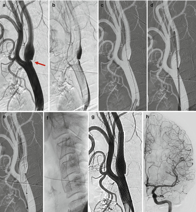 Carotid Artery Stenting for Recurrently Symptomatic Carotid Web: An ...