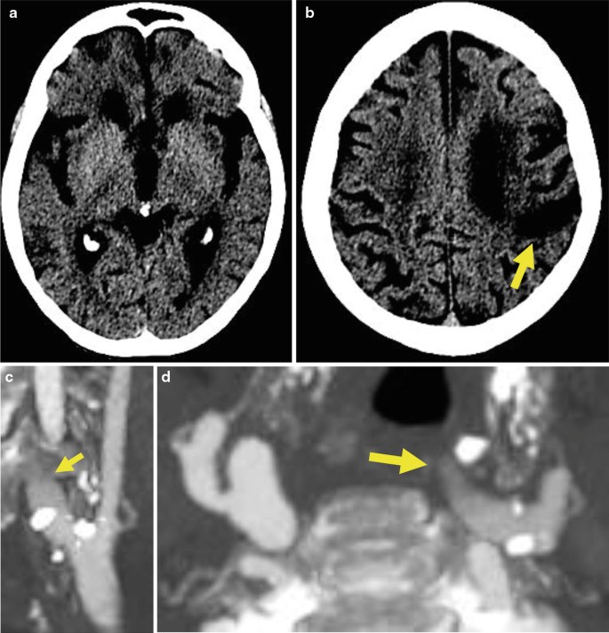 Successful Mechanical Thrombectomy Rescue with the NeVa Stent Retriever ...
