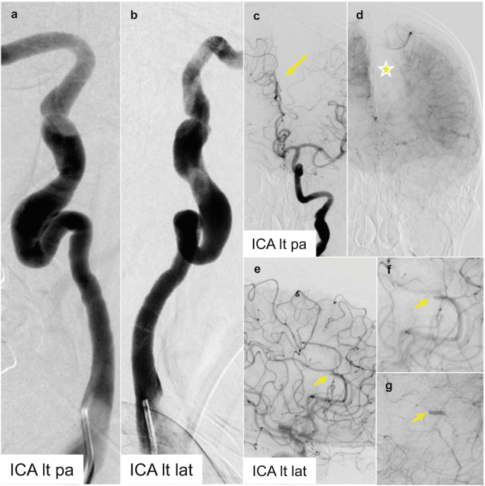 Endovascular Treatment of an Acute Embolic Anterior Cerebral Artery ...