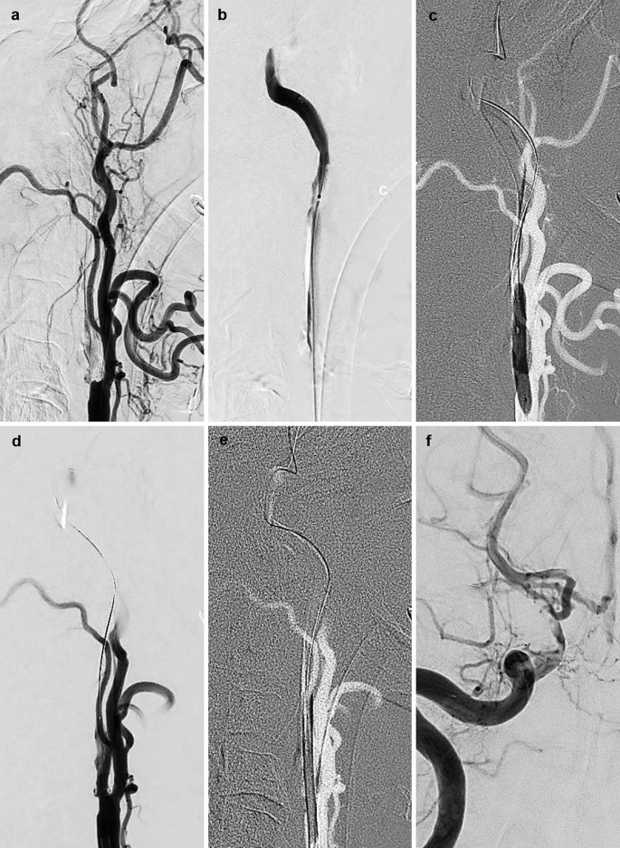 Tandem Extracranial and Intracranial ICA Occlusions Treated Through ...