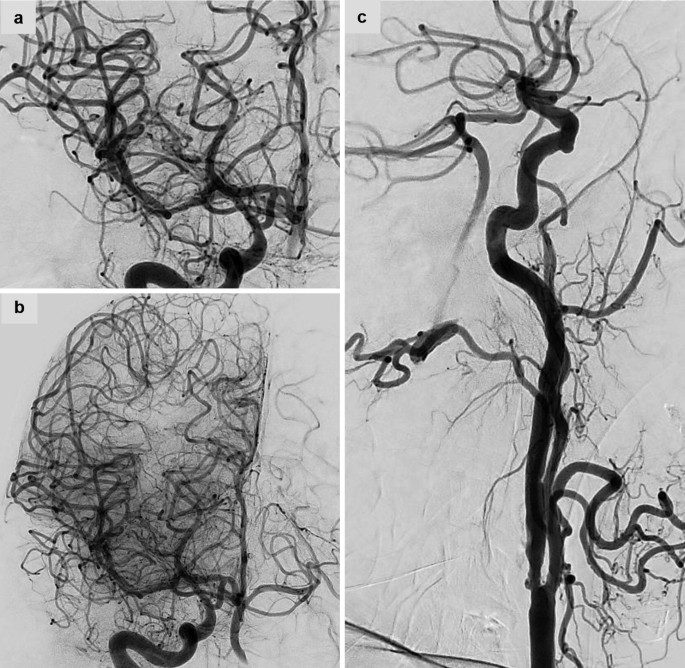 Tandem Extracranial and Intracranial ICA Occlusions Treated Through ...