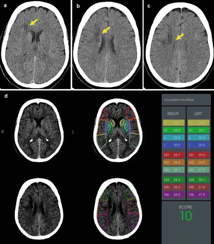 Fatal Hemorrhage Complicating Intracranial Stenting After Failed ...