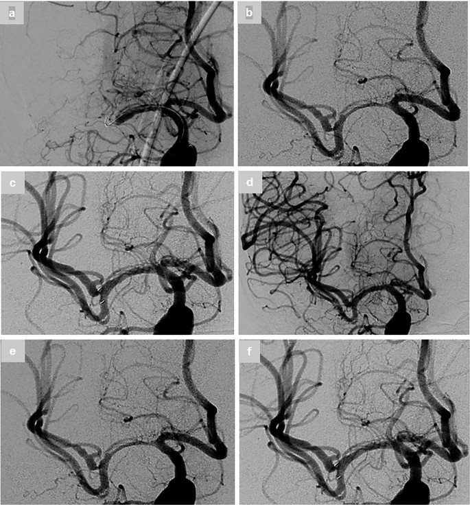 Stentriever Angioplasty (Stent-Plasty) for Post-Embolectomy Segmental ...