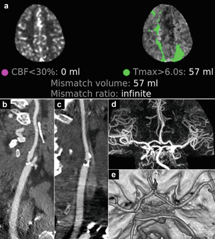 Carotid Artery Stenting for Symptomatic Cortical Border Zone/Watershed ...