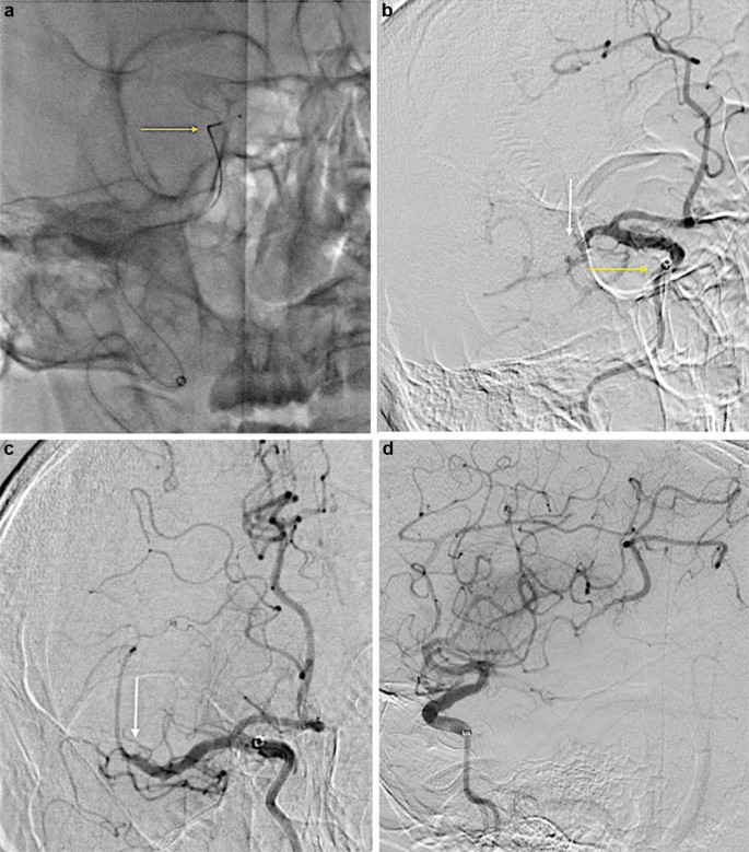 Endovascular Treatment of Acute Ischemic Stroke Due to Tandem Occlusion ...