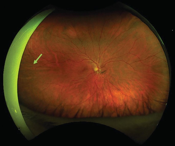 Applied Anatomy for the Vitreoretinal Surgeon | SpringerLink