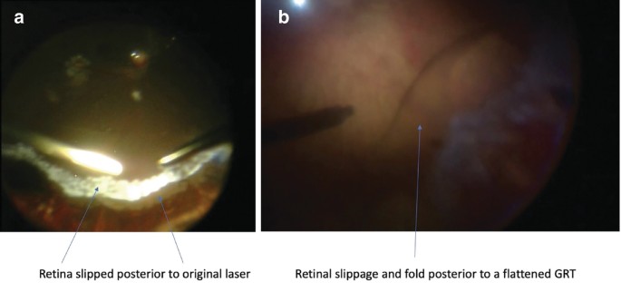 Giant Retinal Tears | SpringerLink