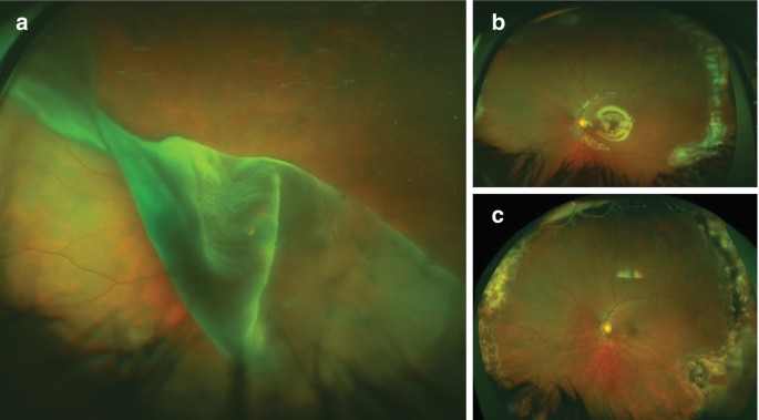 Giant Retinal Tears | SpringerLink