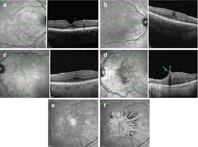Surgical Management of Epiretinal Membranes and Vitreomacular Traction ...