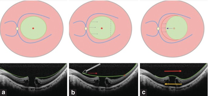 Surgical Management of Macular Holes | SpringerLink