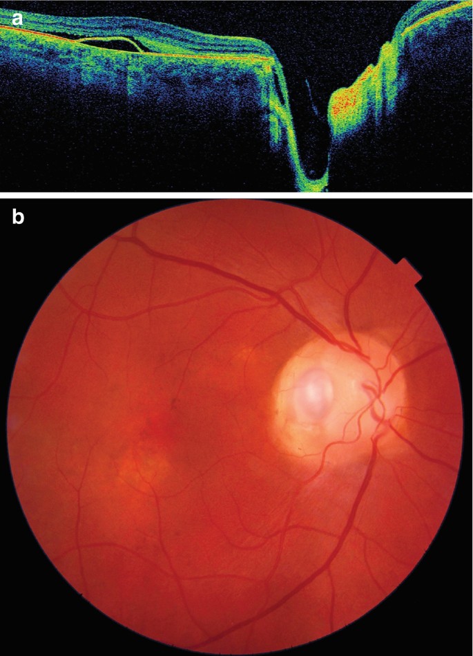 Optic Disc Pit-Associated Maculopathy | SpringerLink