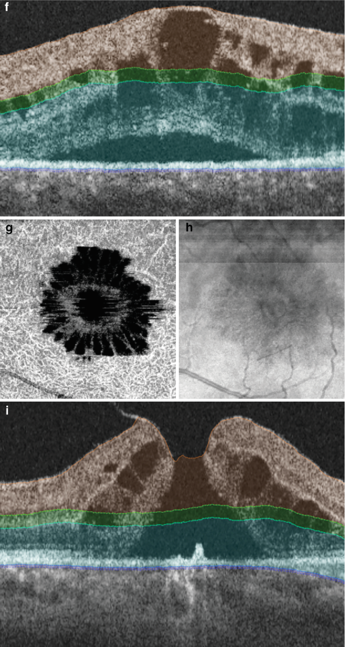 Optic Disc Pit-Associated Maculopathy | SpringerLink