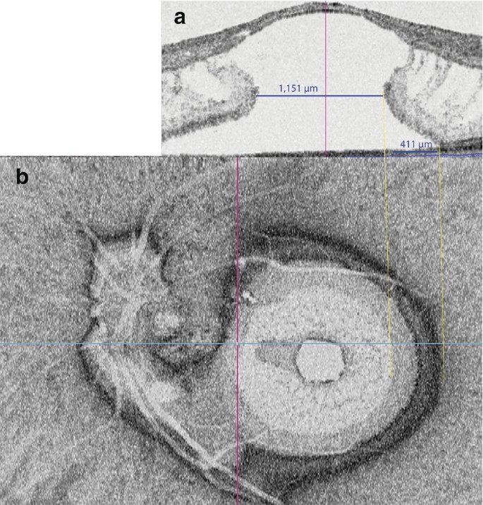 Optic Disc Pit-Associated Maculopathy | SpringerLink
