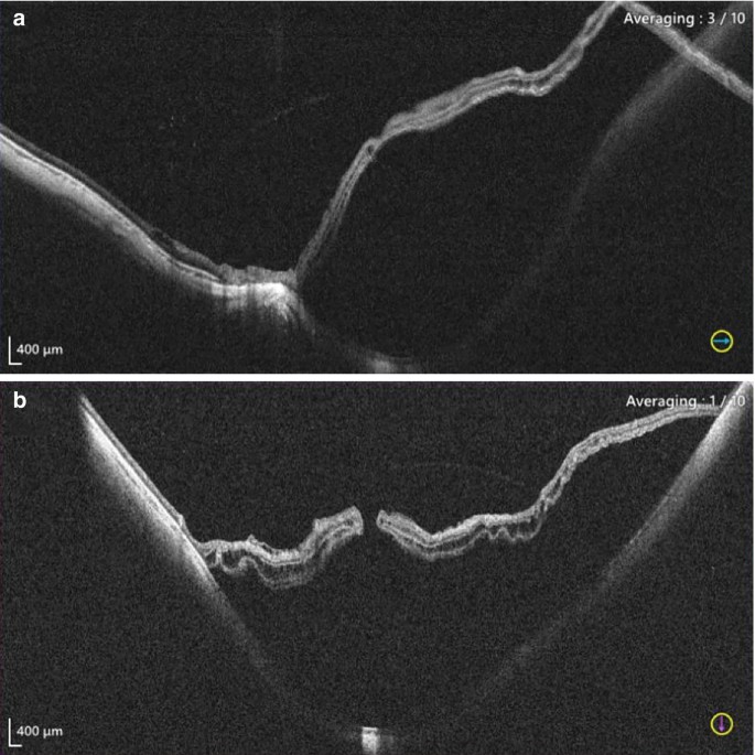 Myopic Traction Maculopathy | SpringerLink