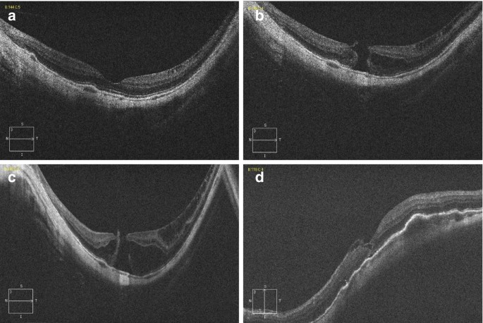 Myopic Traction Maculopathy | SpringerLink