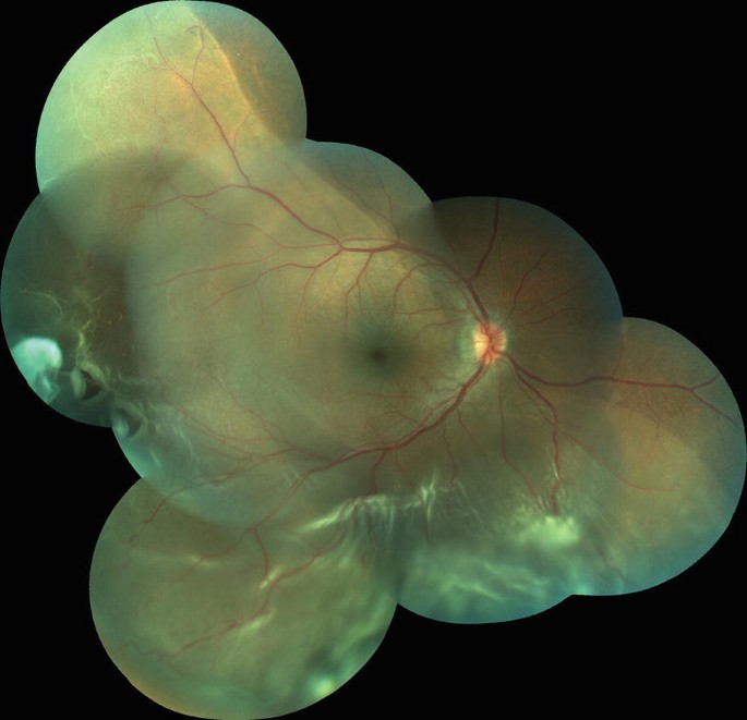 Surgery for Sickle Cell Retinopathy | SpringerLink