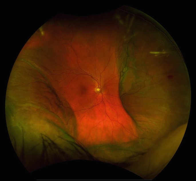 Suprachoroidal Hemorrhage | SpringerLink