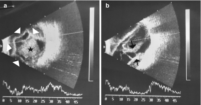Suprachoroidal Hemorrhage | SpringerLink
