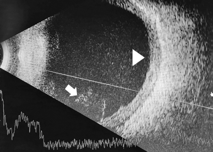 Suprachoroidal Hemorrhage | SpringerLink