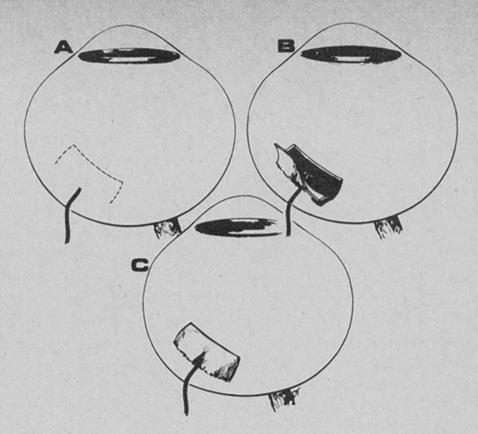 Idiopathic Uveal Effusion Syndrome | SpringerLink