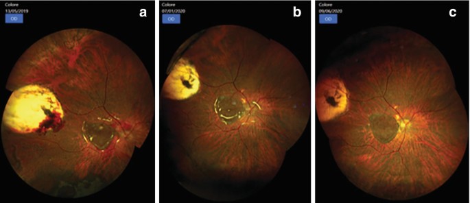 Retinal Pigment Epithelium and Choroid Transplantation | SpringerLink