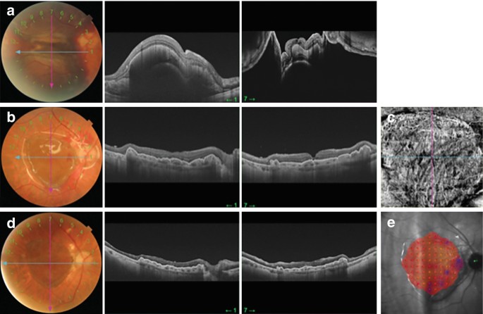 Retinal Pigment Epithelium and Choroid Transplantation | SpringerLink