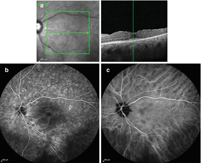 Vitreoretinal Surgery in Uveitis | SpringerLink