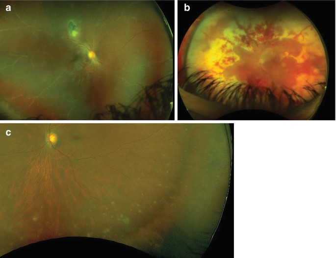 Vitreoretinal Surgery in Uveitis | SpringerLink