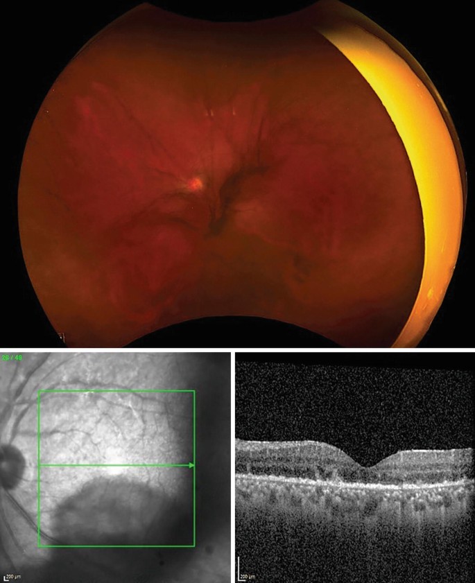 Vitreoretinal Surgery in Uveitis | SpringerLink