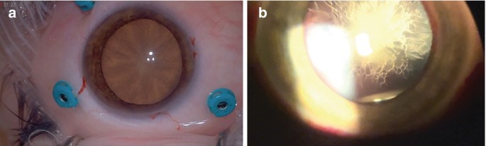 Cataract Surgery and Vitreoretinal Surgery | SpringerLink