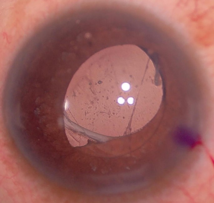 Cataract Surgery and Vitreoretinal Surgery | SpringerLink