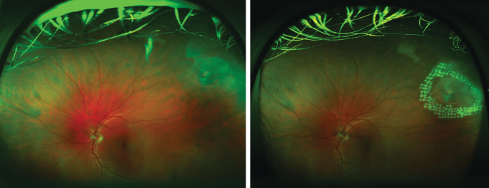 Retinopexy for Retinal Tears and Pneumatic Retinopexy for Primary ...