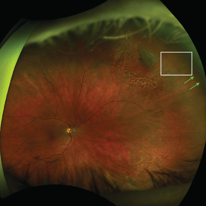 Retinopexy for Retinal Tears and Pneumatic Retinopexy for Primary ...
