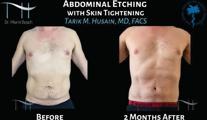 Abdominal Etching for Male Bodybuilders | SpringerLink