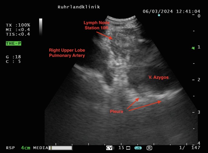 Linear Endobronchial Ultrasound | SpringerLink